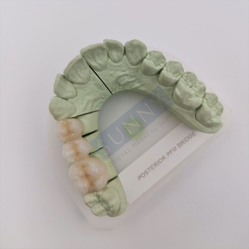 PFM (Porcelain-Fused-To-Metal) - Sunny Dental Medical Supply